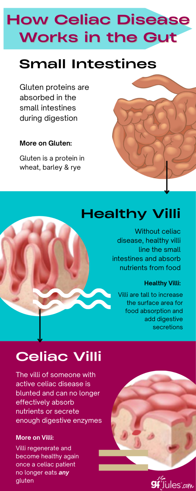Celiac Disease -- What it is, what it isn't--knowing the difference